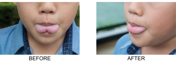 Oral Functions – Orofacial Myology